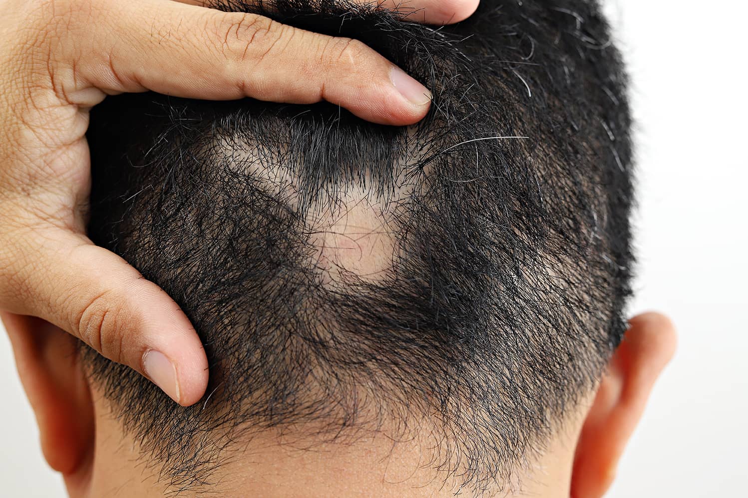 Ulcerative Alopecia | AI DERMA CLINIC