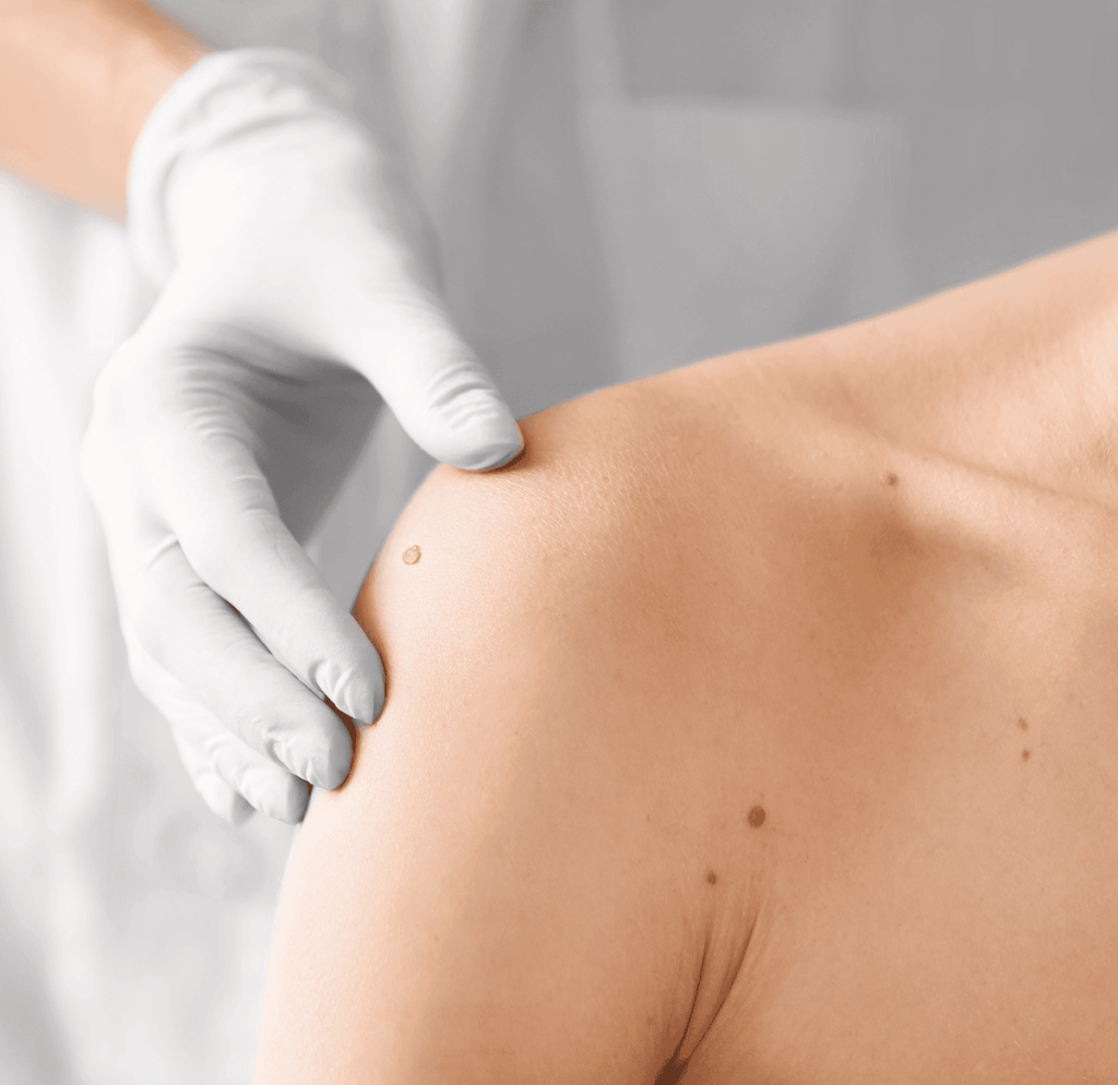 Biopsy | AI DERMA CLINIC